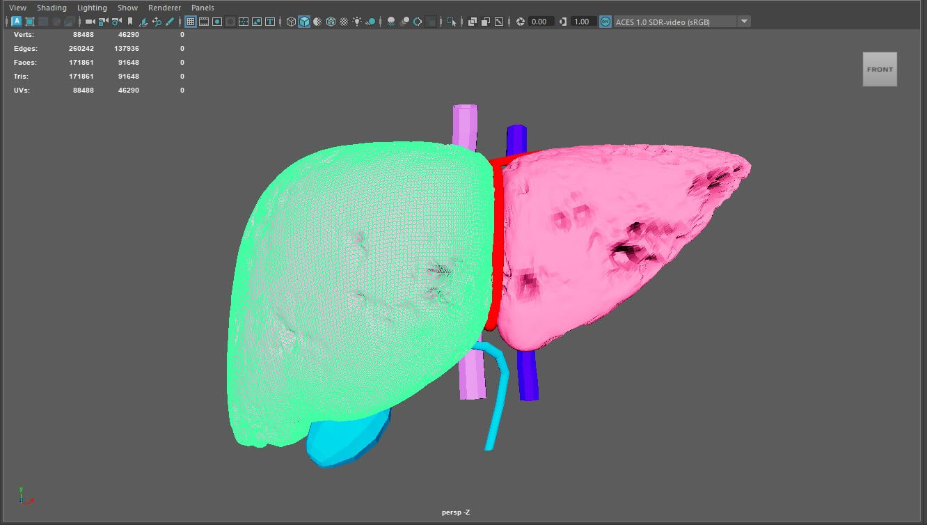 3D Model of Liver With Non-Alchocolic Steatohepatitis (Nash) by azekapeka