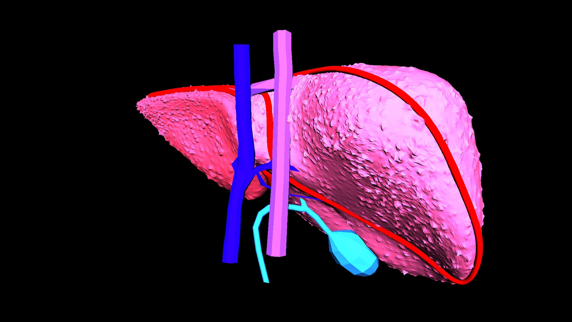 3D Model of Liver With Steatosis by azekapeka