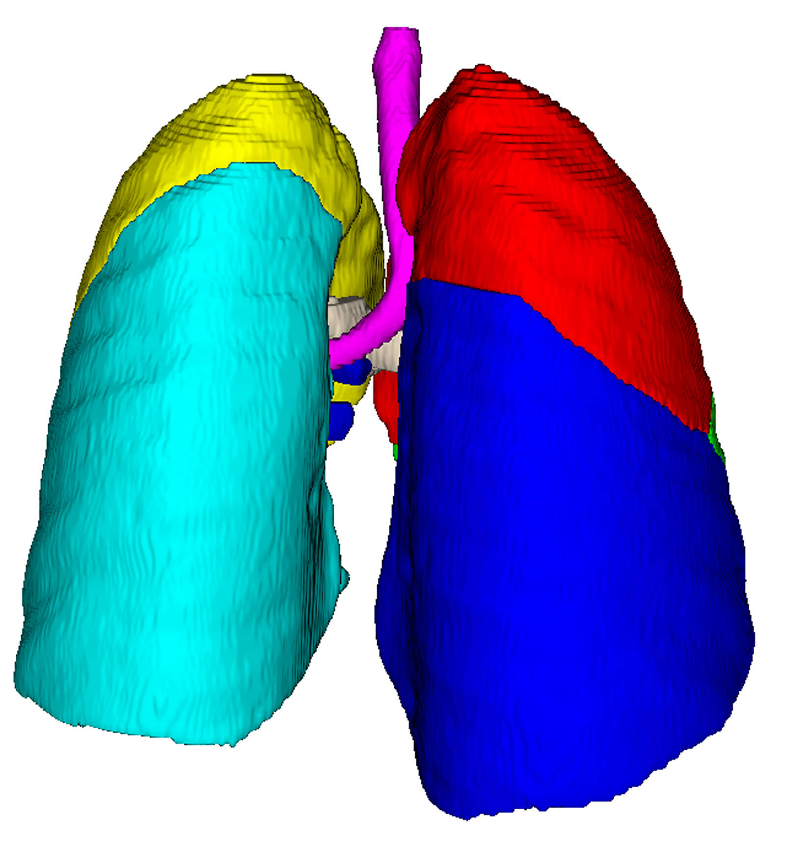 3D Model of Lungs, Vessels and Airways - From Real Patient by azekapeka