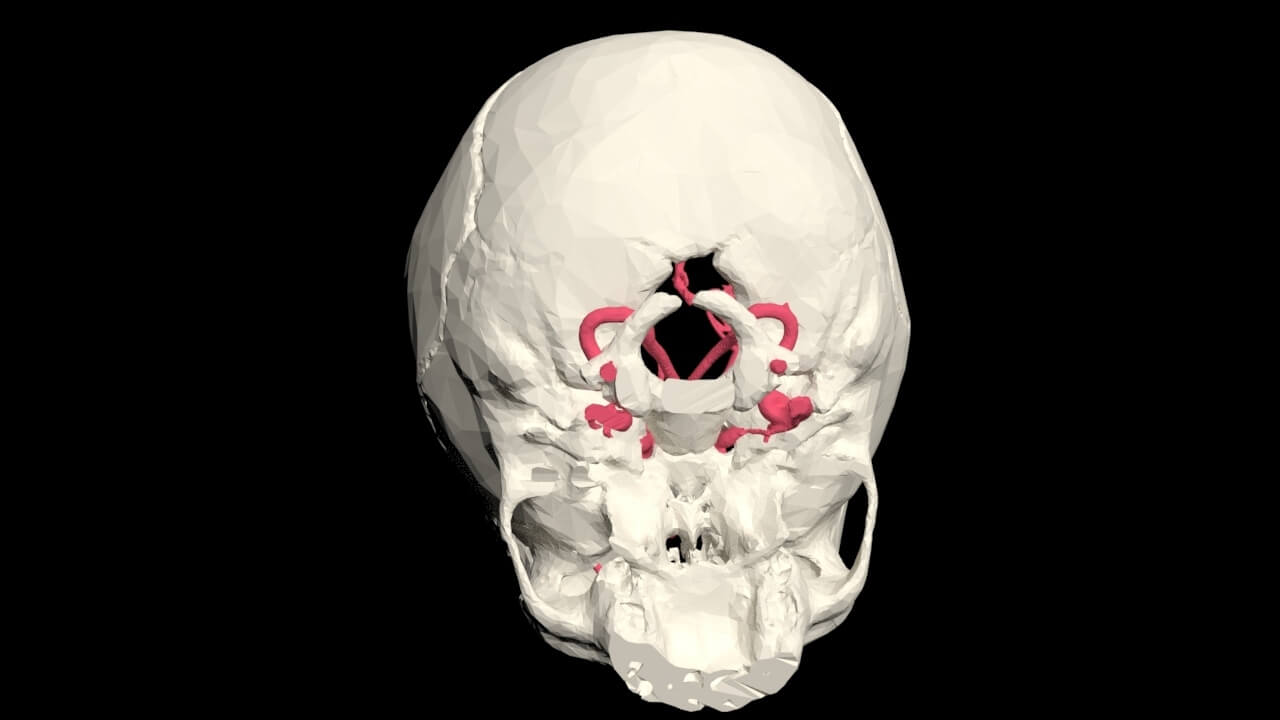 3D Model of Middle Cerebral Artery (Mca) Aneurysm by azekapeka