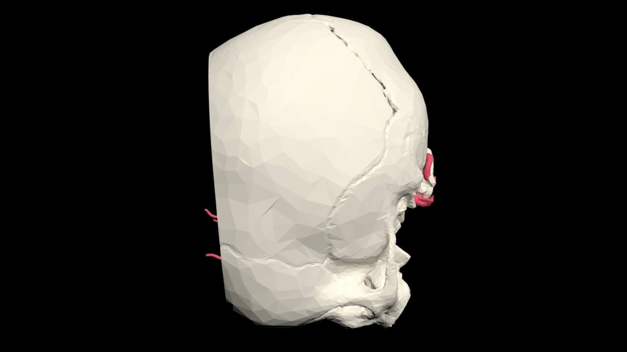 3D Model of Middle Cerebral Artery (Mca) Aneurysm by azekapeka