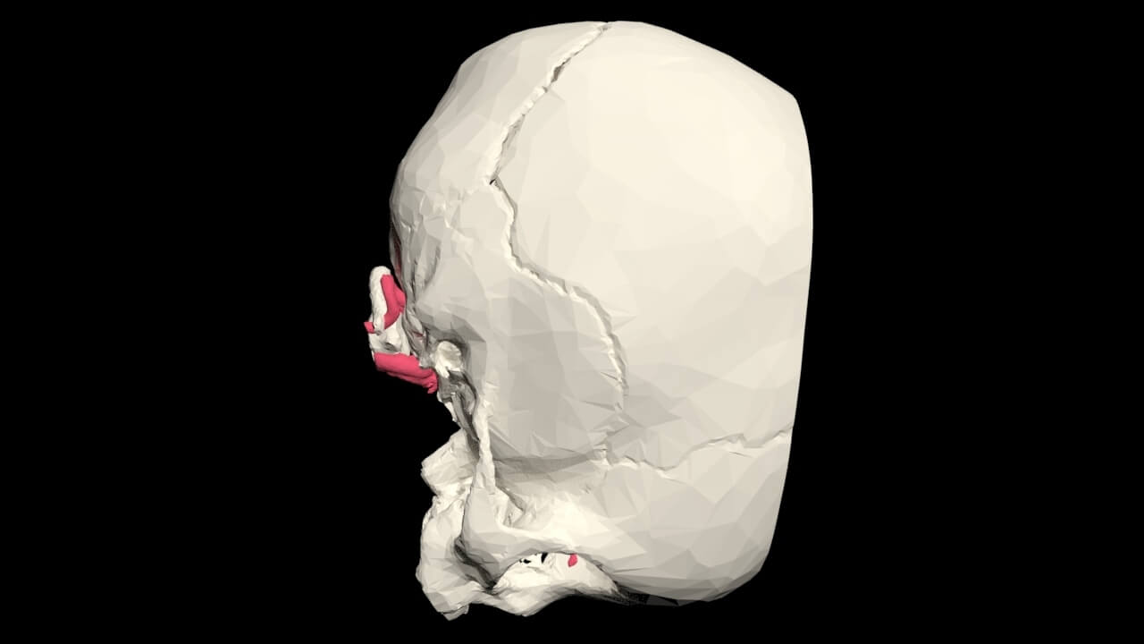 3D Model of Middle Cerebral Artery (Mca) Aneurysm by azekapeka