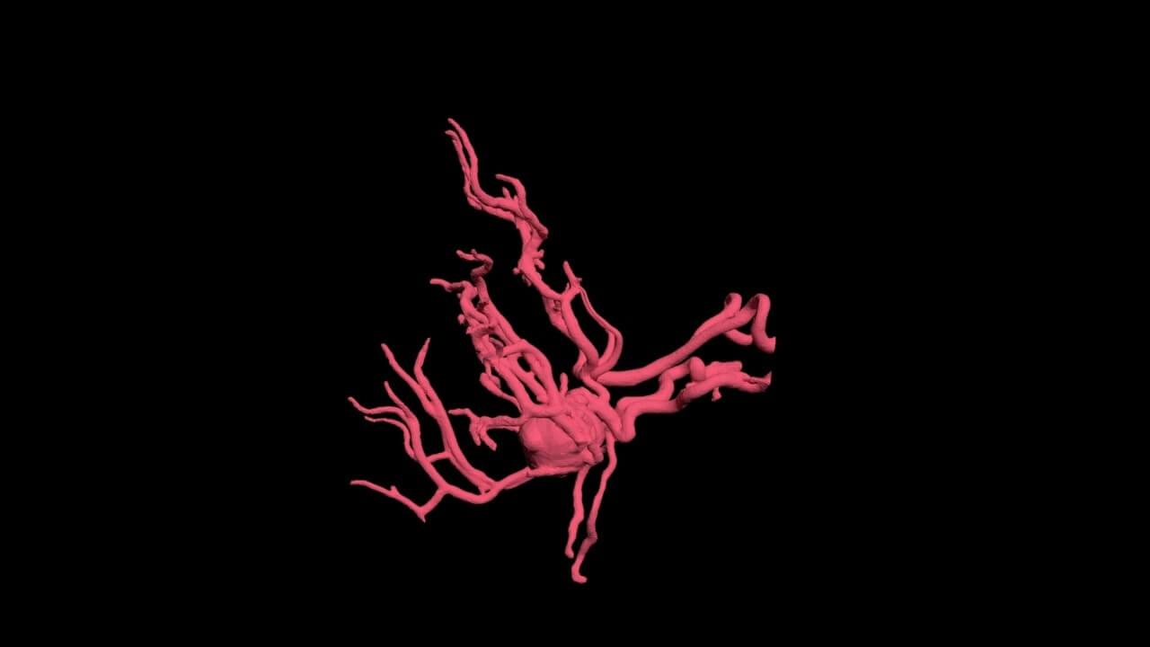 3D Model of Middle Cerebral Artery (Mca) Aneurysm by azekapeka