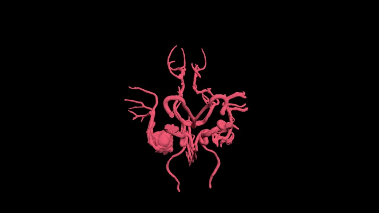 3D Model of Middle Cerebral Artery (Mca) Aneurysm by azekapeka