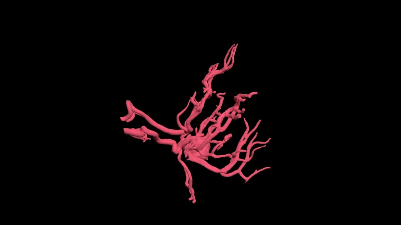 3D Model of Middle Cerebral Artery (Mca) Aneurysm by azekapeka