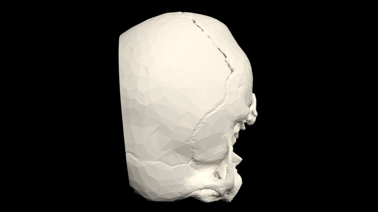 3D Model of Middle Cerebral Artery (Mca) Aneurysm by azekapeka