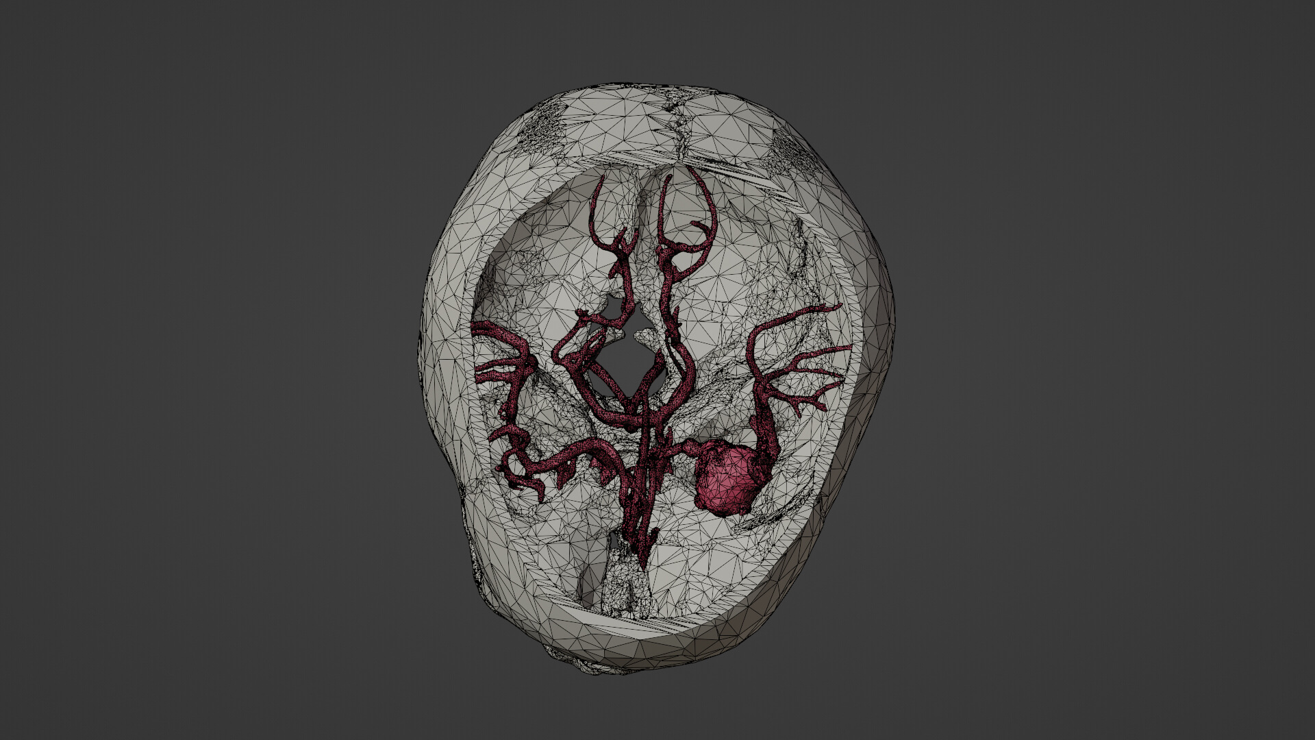3D Model of Middle Cerebral Artery (Mca) Aneurysm by azekapeka