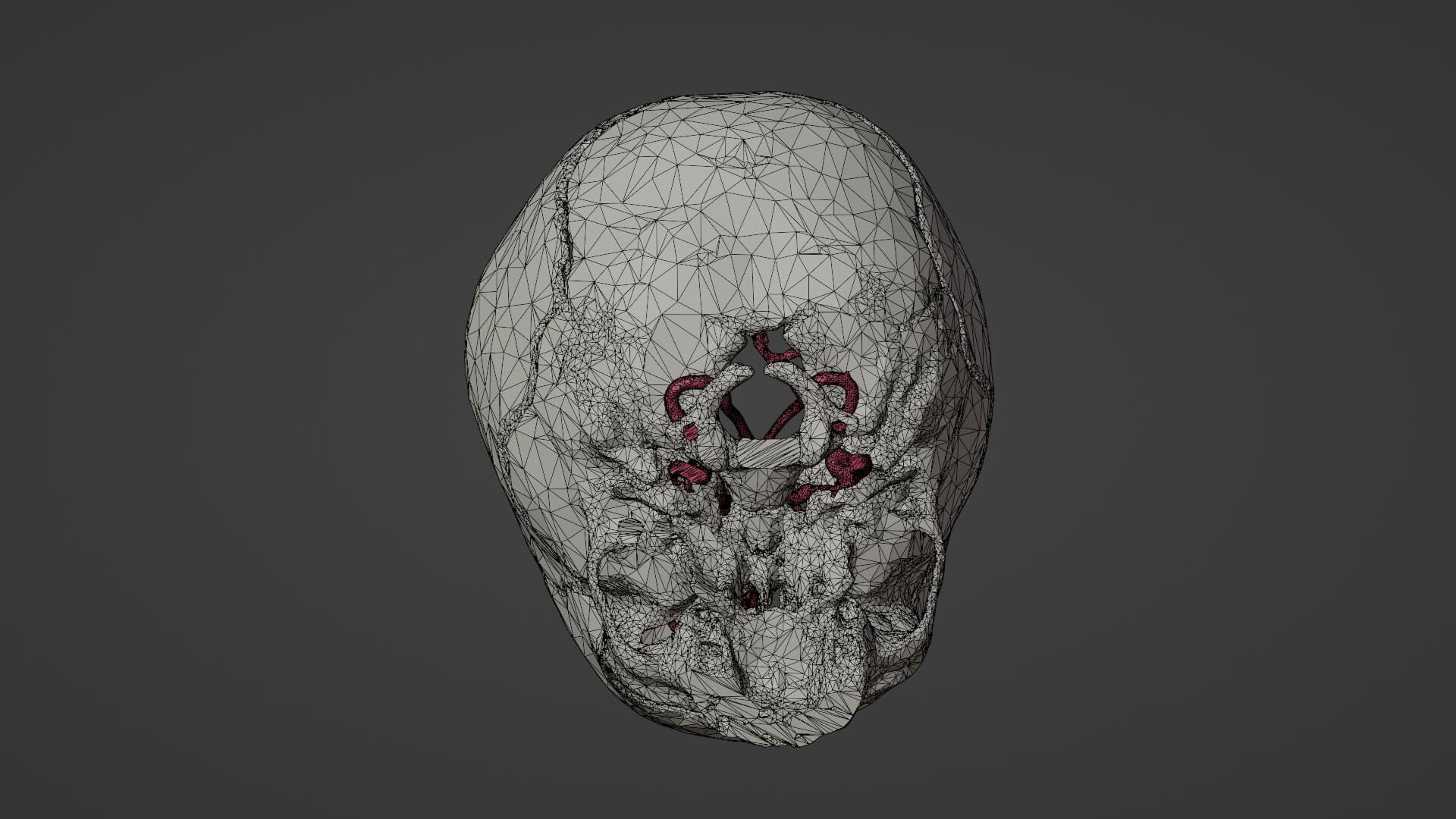 3D Model of Middle Cerebral Artery (Mca) Aneurysm by azekapeka