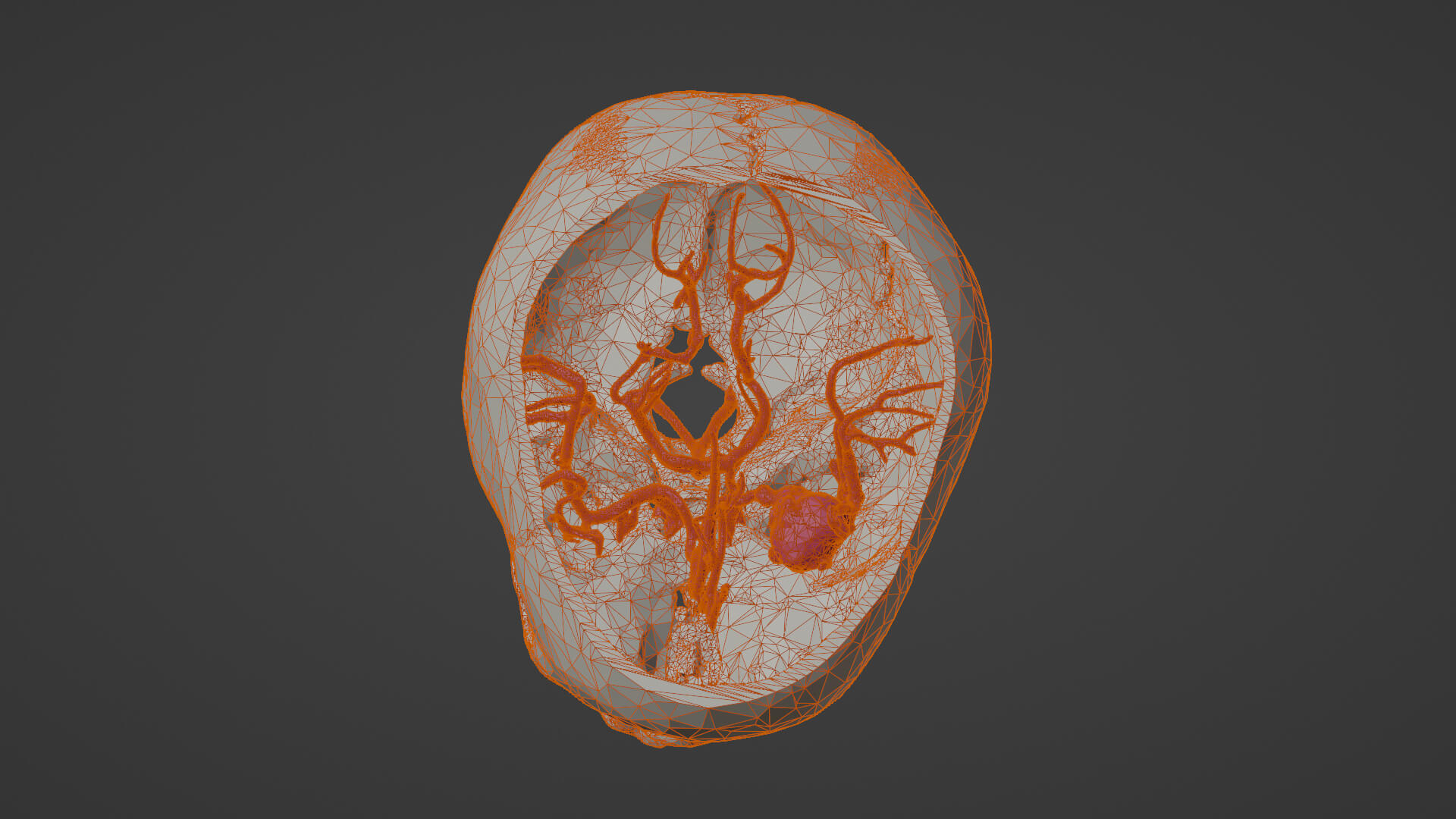 3D Model of Middle Cerebral Artery (Mca) Aneurysm by azekapeka