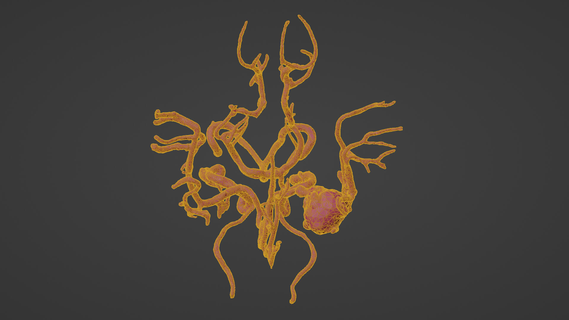 3D Model of Middle Cerebral Artery (Mca) Aneurysm by azekapeka