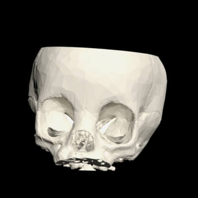3D Model of Middle Cerebral Artery (Mca) Aneurysm by azekapeka