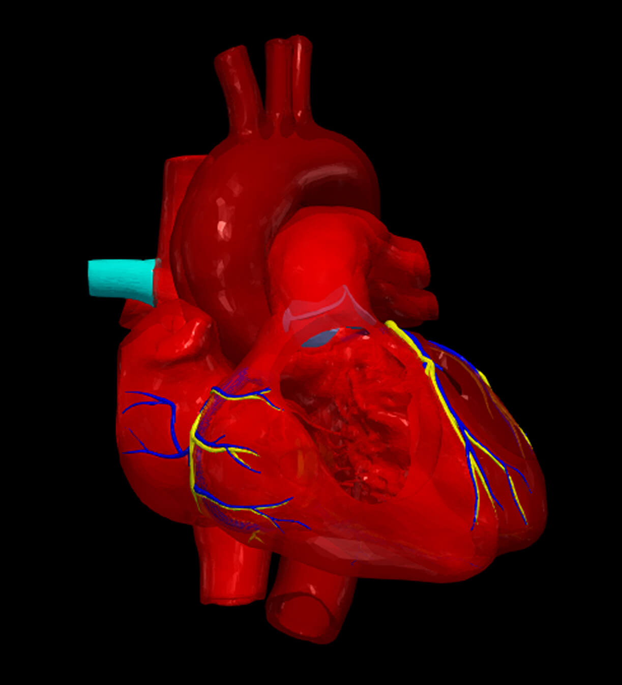 3D Model of Partial Anomalous Pulmonary Venous Connection by azekapeka