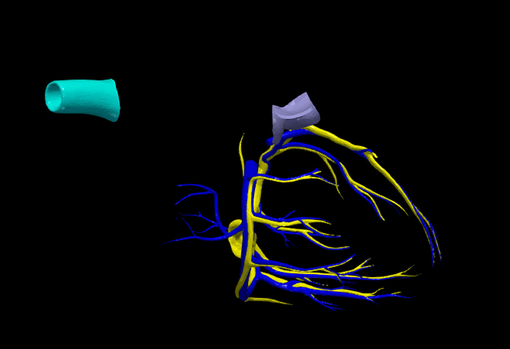 3D Model of Partial Anomalous Pulmonary Venous Connection by azekapeka