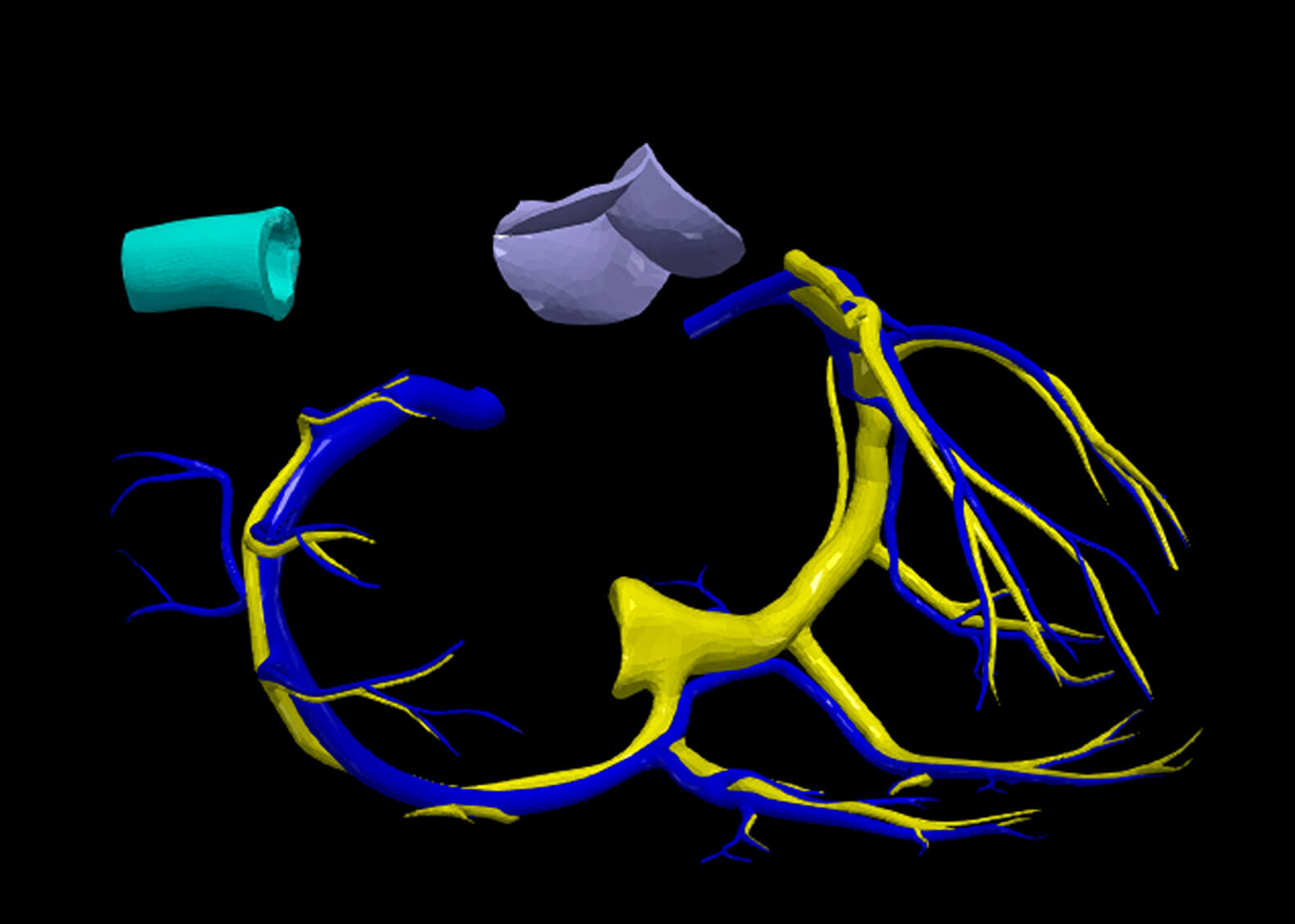 3D Model of Partial Anomalous Pulmonary Venous Connection by azekapeka
