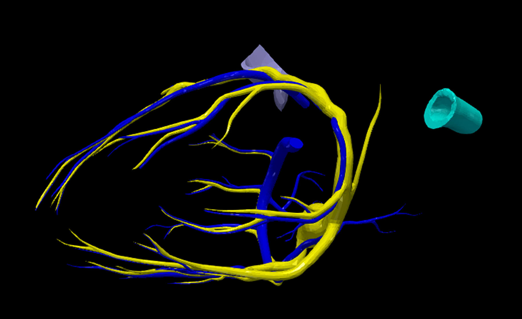 3D Model of Partial Anomalous Pulmonary Venous Connection by azekapeka