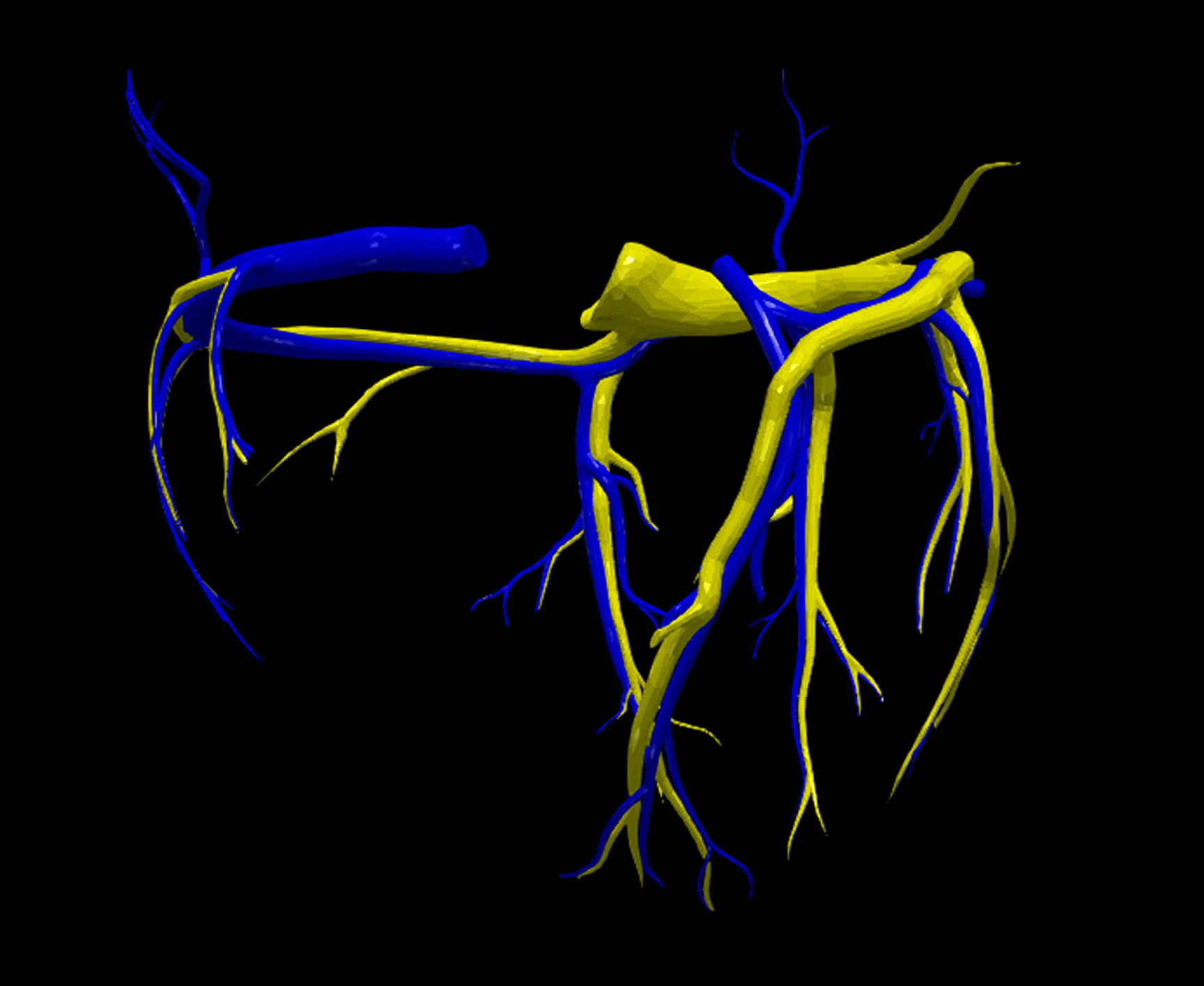 3D Model of Partial Anomalous Pulmonary Venous Connection by azekapeka