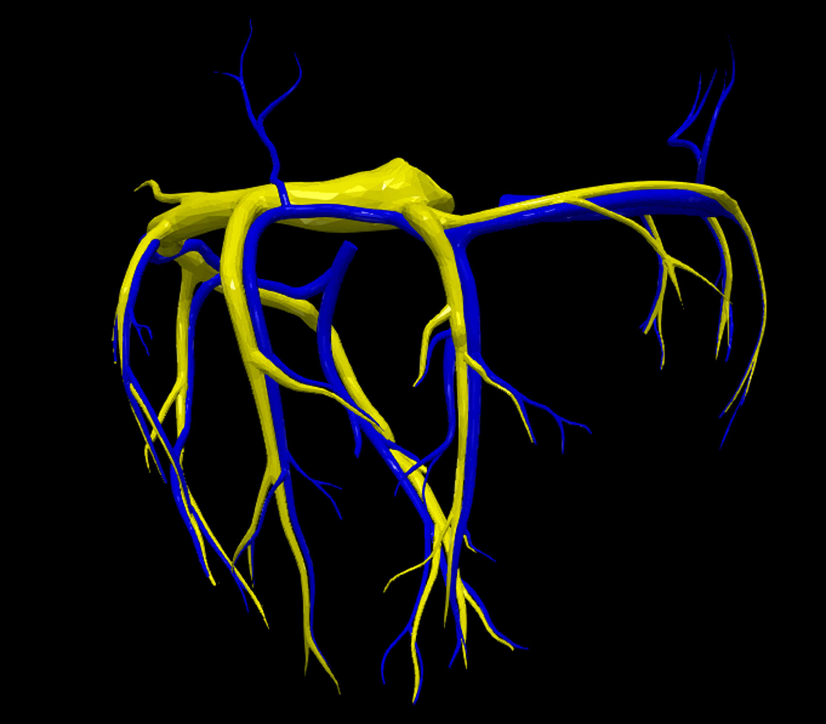 3D Model of Partial Anomalous Pulmonary Venous Connection by azekapeka