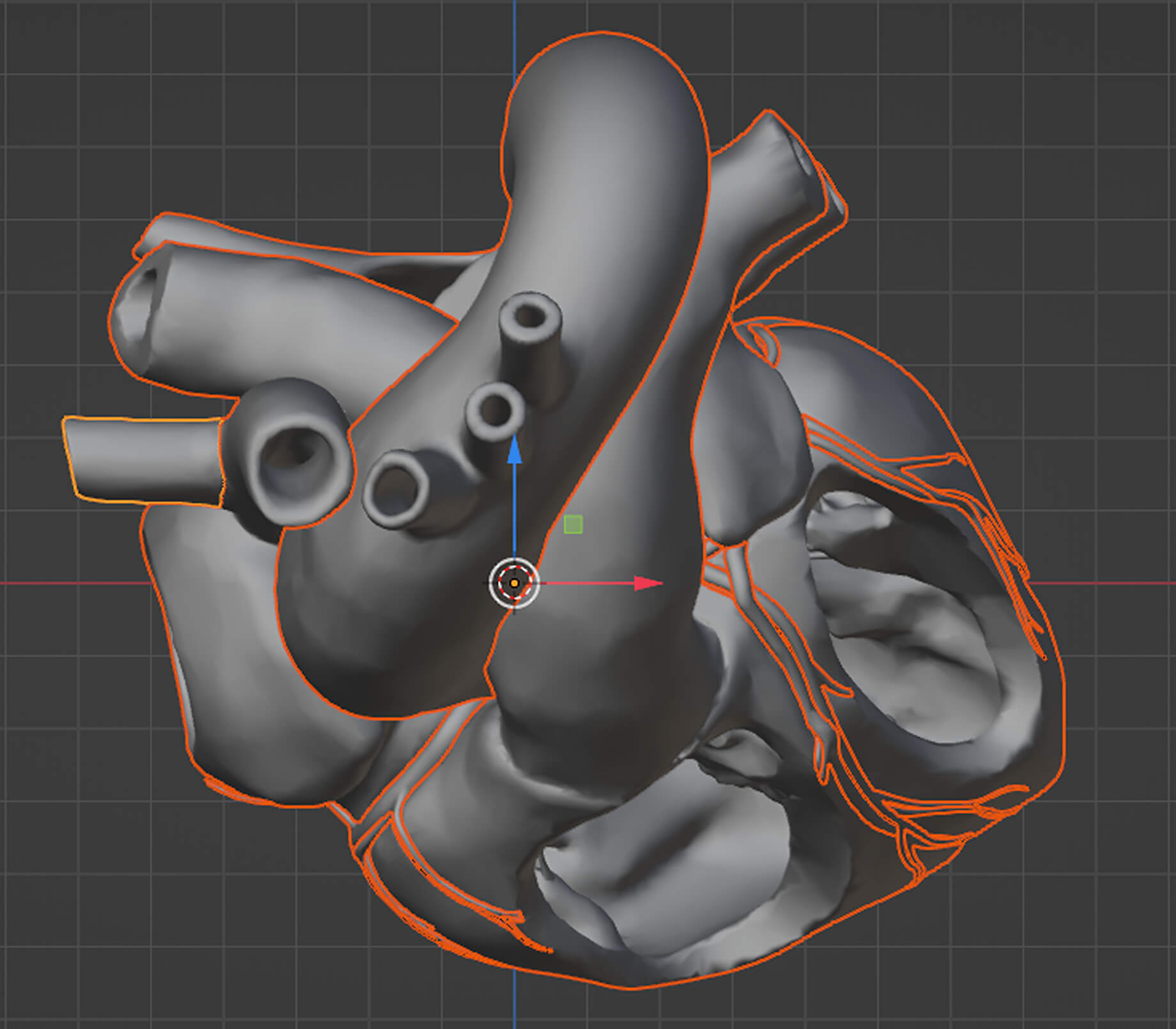 3D Model of Partial Anomalous Pulmonary Venous Connection by azekapeka