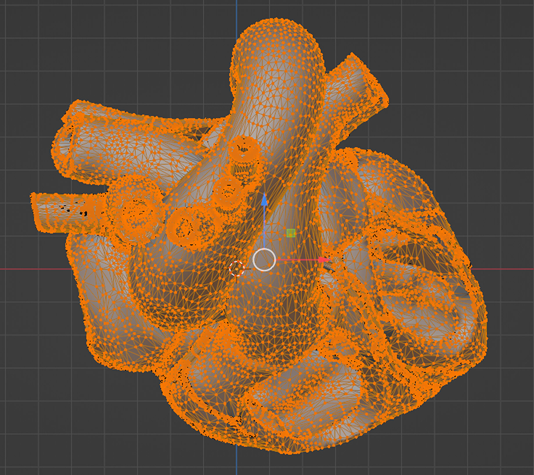 3D Model of Partial Anomalous Pulmonary Venous Connection by azekapeka