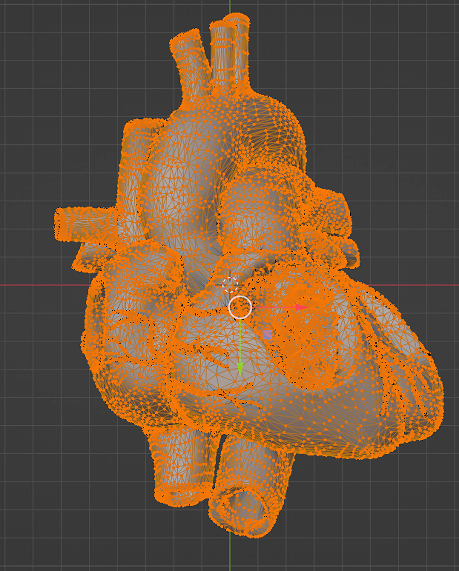 3D Model of Partial Anomalous Pulmonary Venous Connection by azekapeka