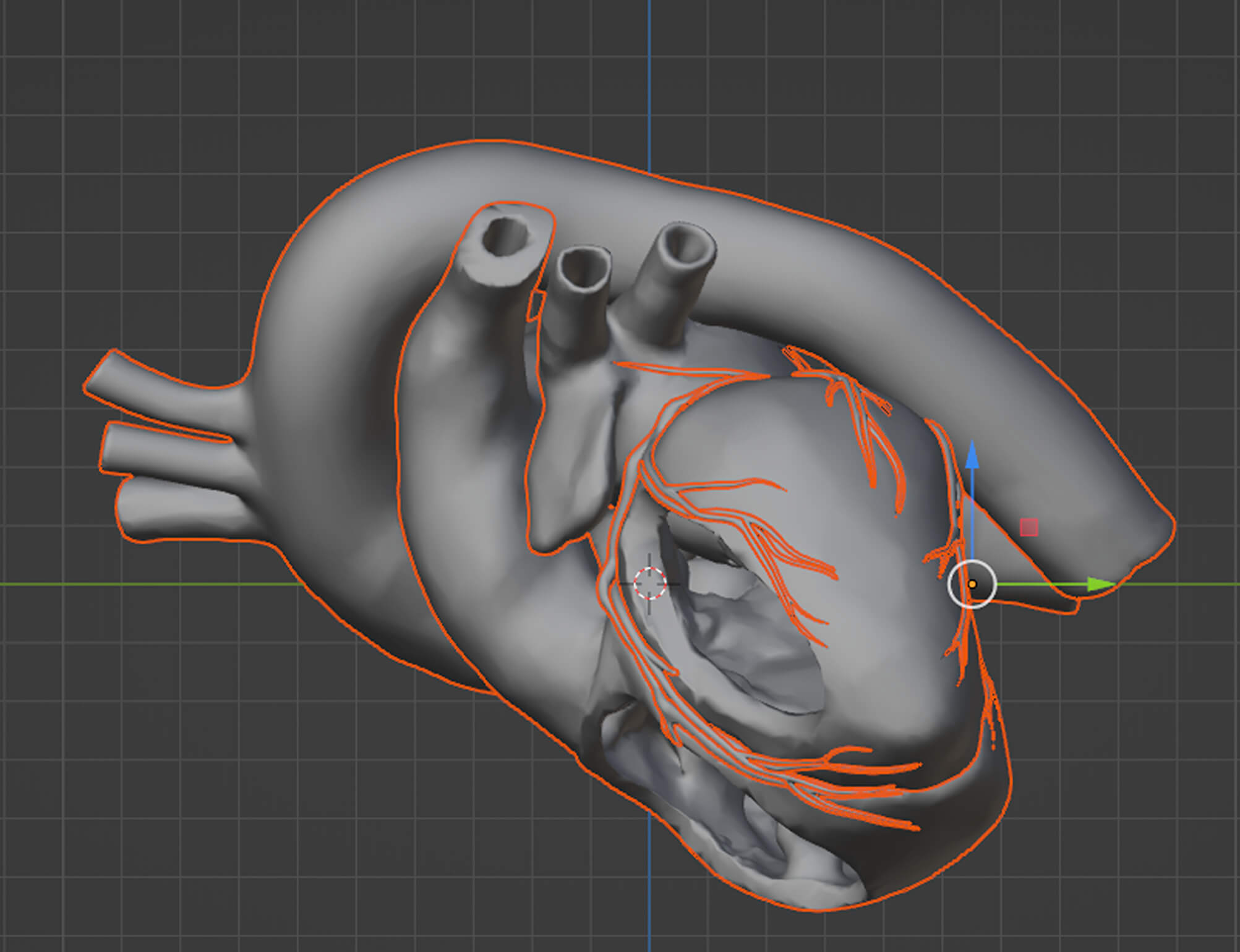 3D Model of Partial Anomalous Pulmonary Venous Connection by azekapeka