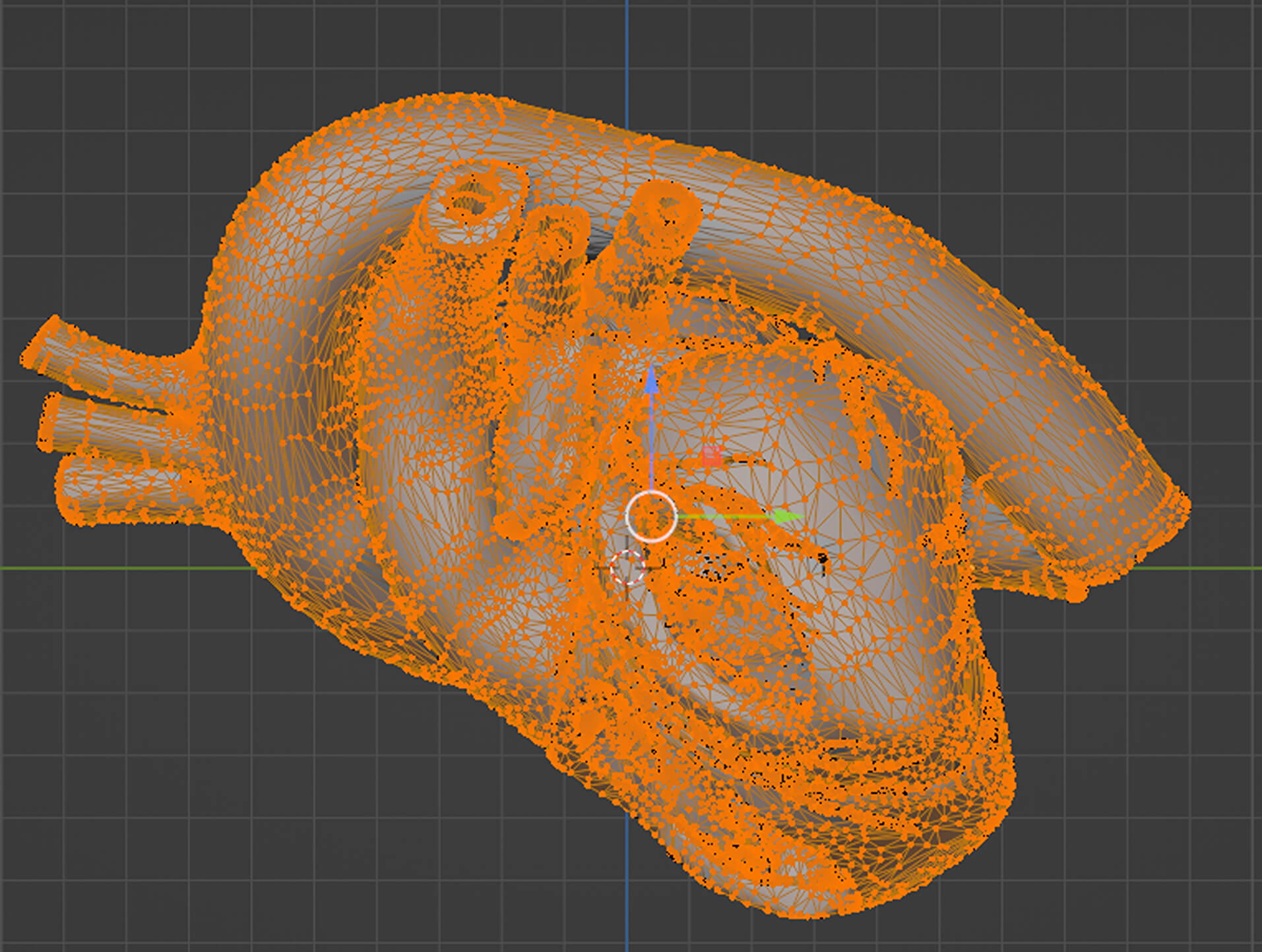 3D Model of Partial Anomalous Pulmonary Venous Connection by azekapeka