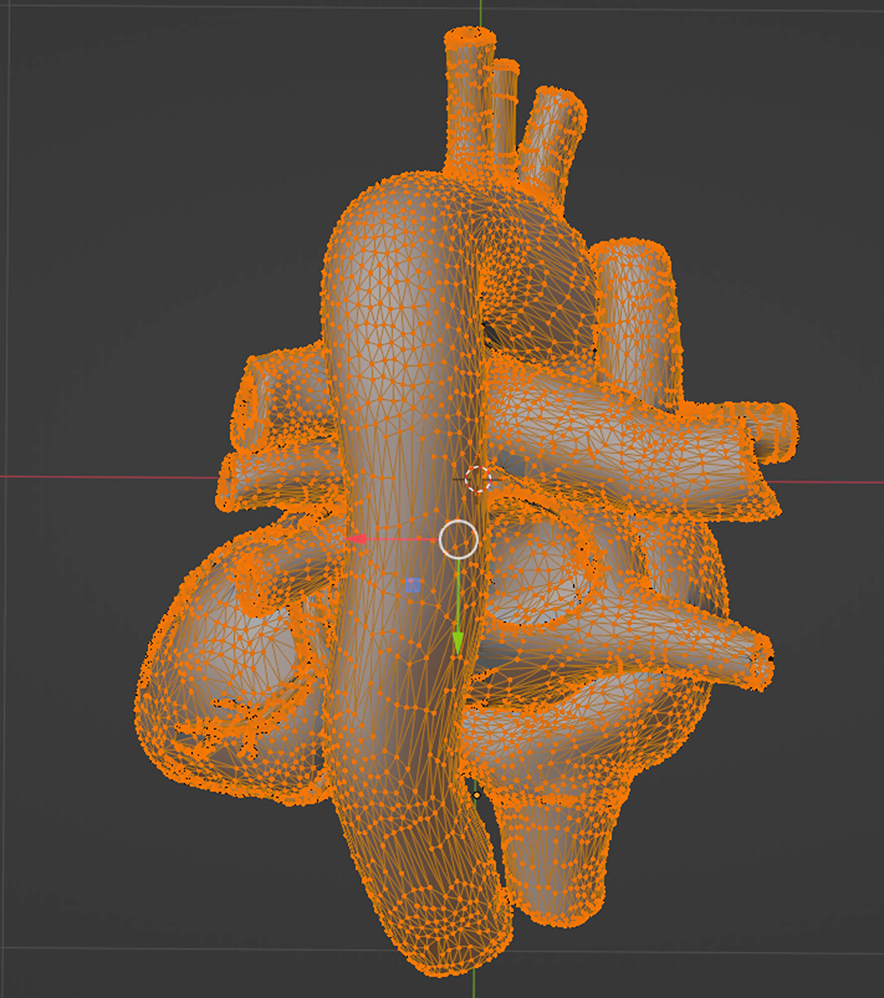 3D Model of Partial Anomalous Pulmonary Venous Connection by azekapeka