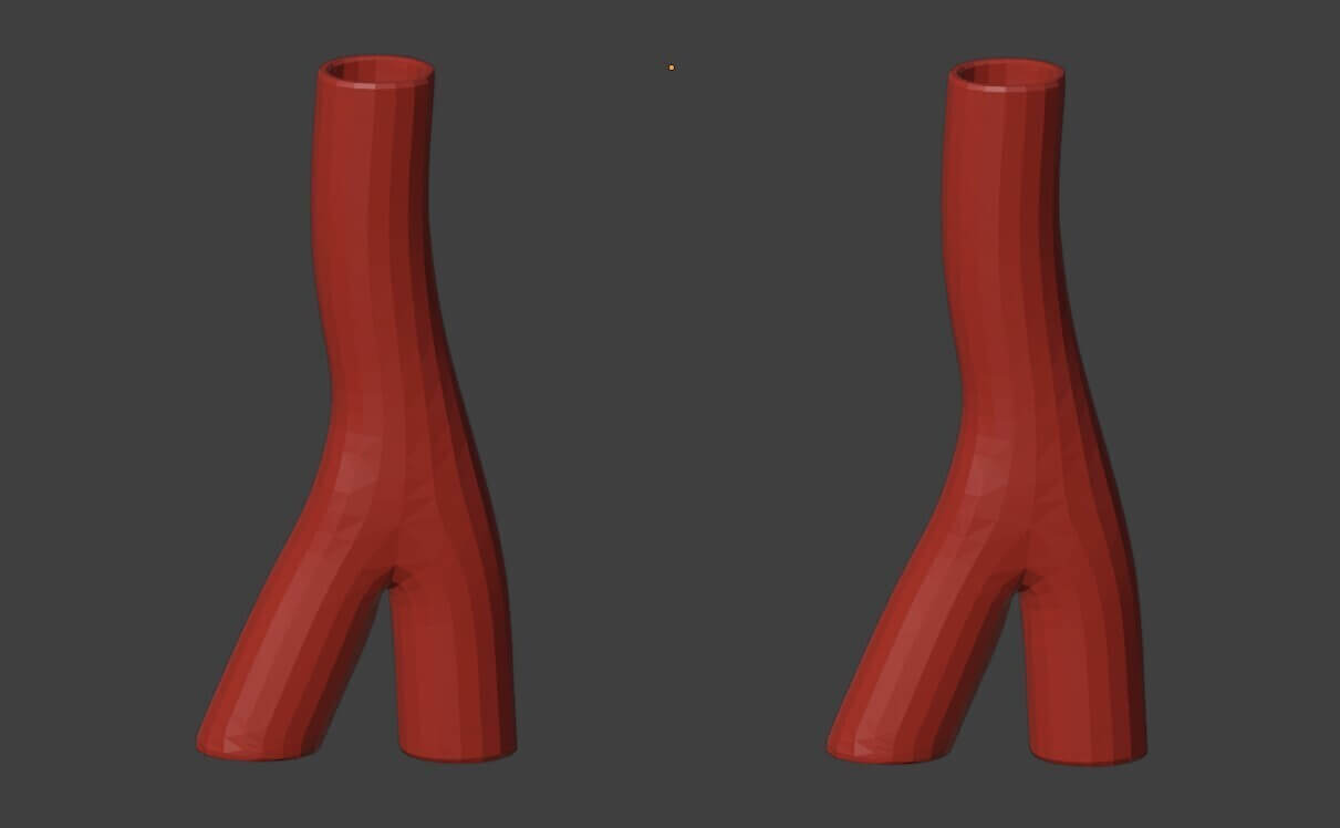 3D Model of Peripheral Artery Disease by azekapeka