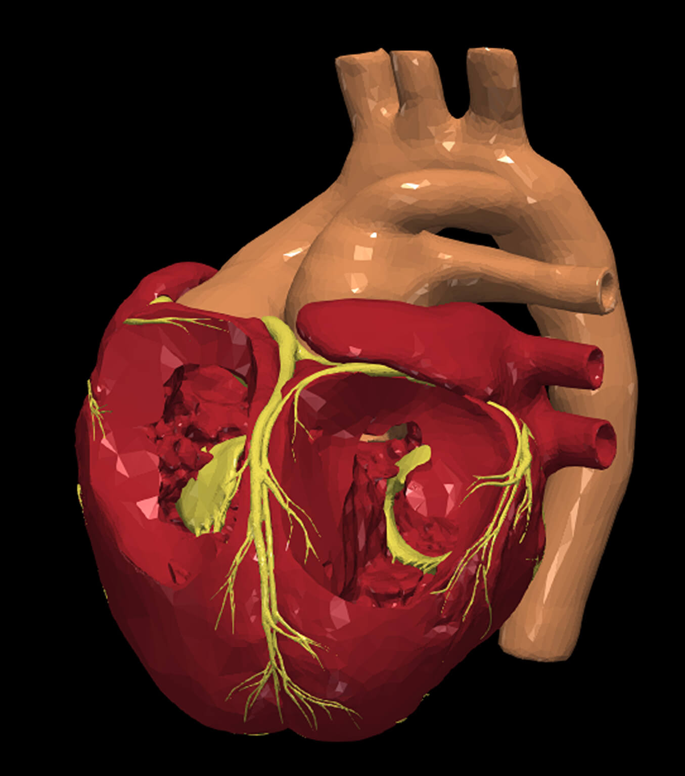 3D Model of Transposition of The Great Arteries Open Duct by azekapeka