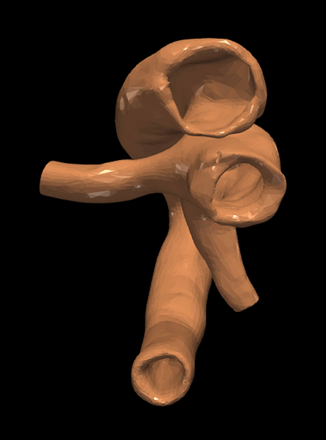 3D Model of Transposition of The Great Arteries Open Duct by azekapeka