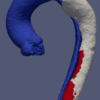 3D Model of Type-B Aortic Dissection (Tbad) by azekapeka
