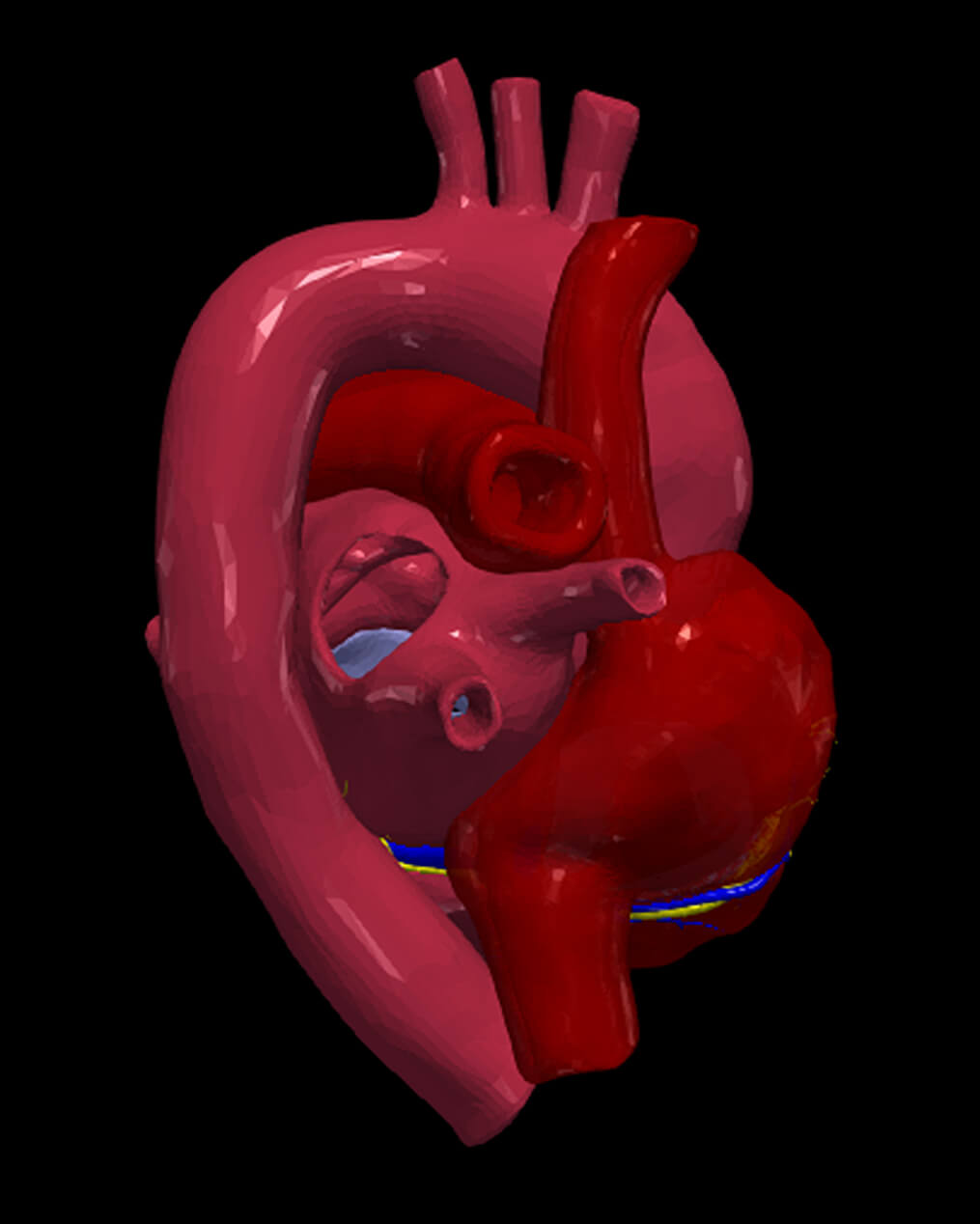 3D Model of Ventricular Septal Defect by azekapeka