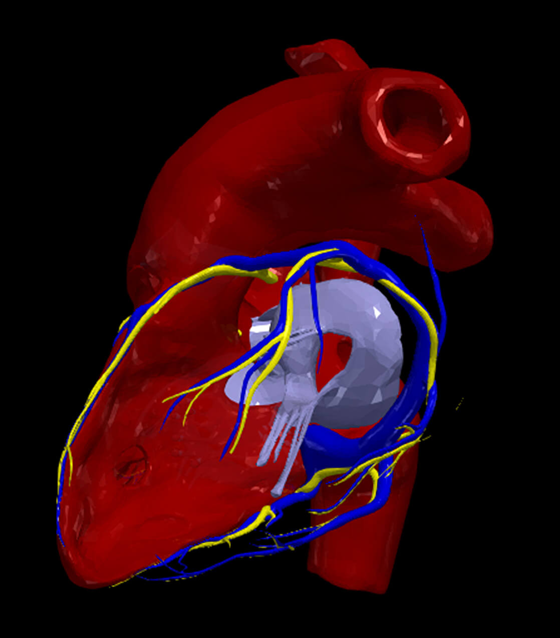 3D Model of Ventricular Septal Defect by azekapeka