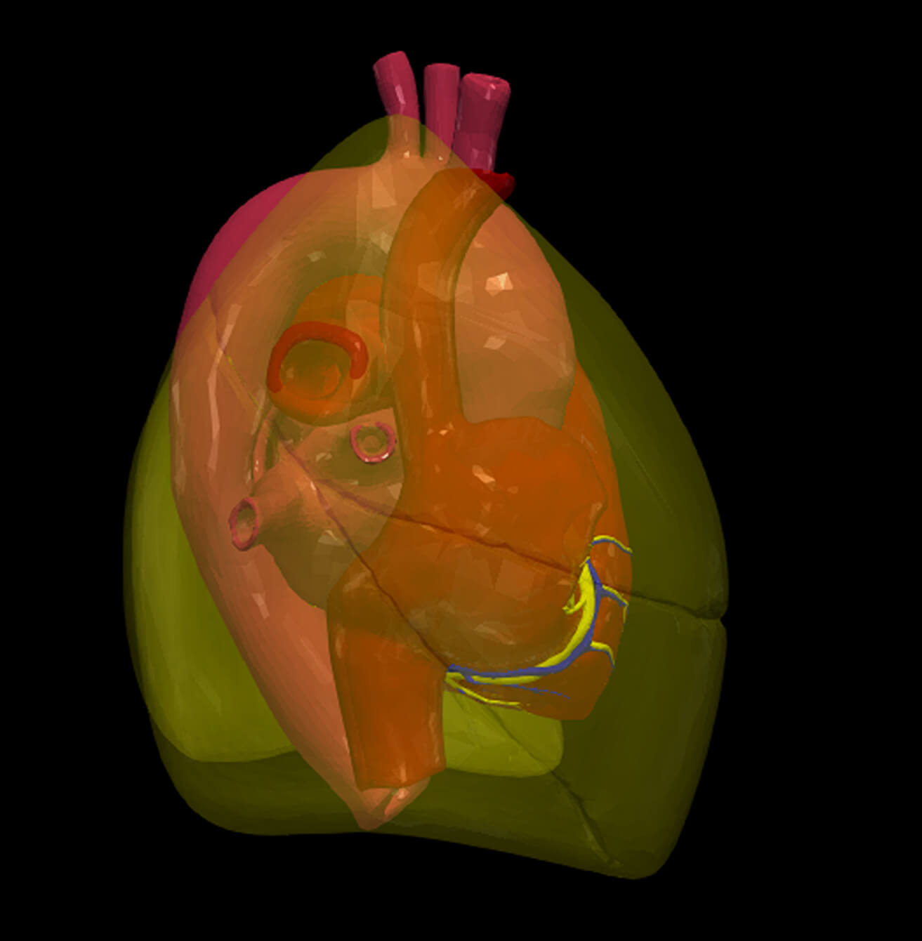3D Model of Ventricular Septal Defect by azekapeka