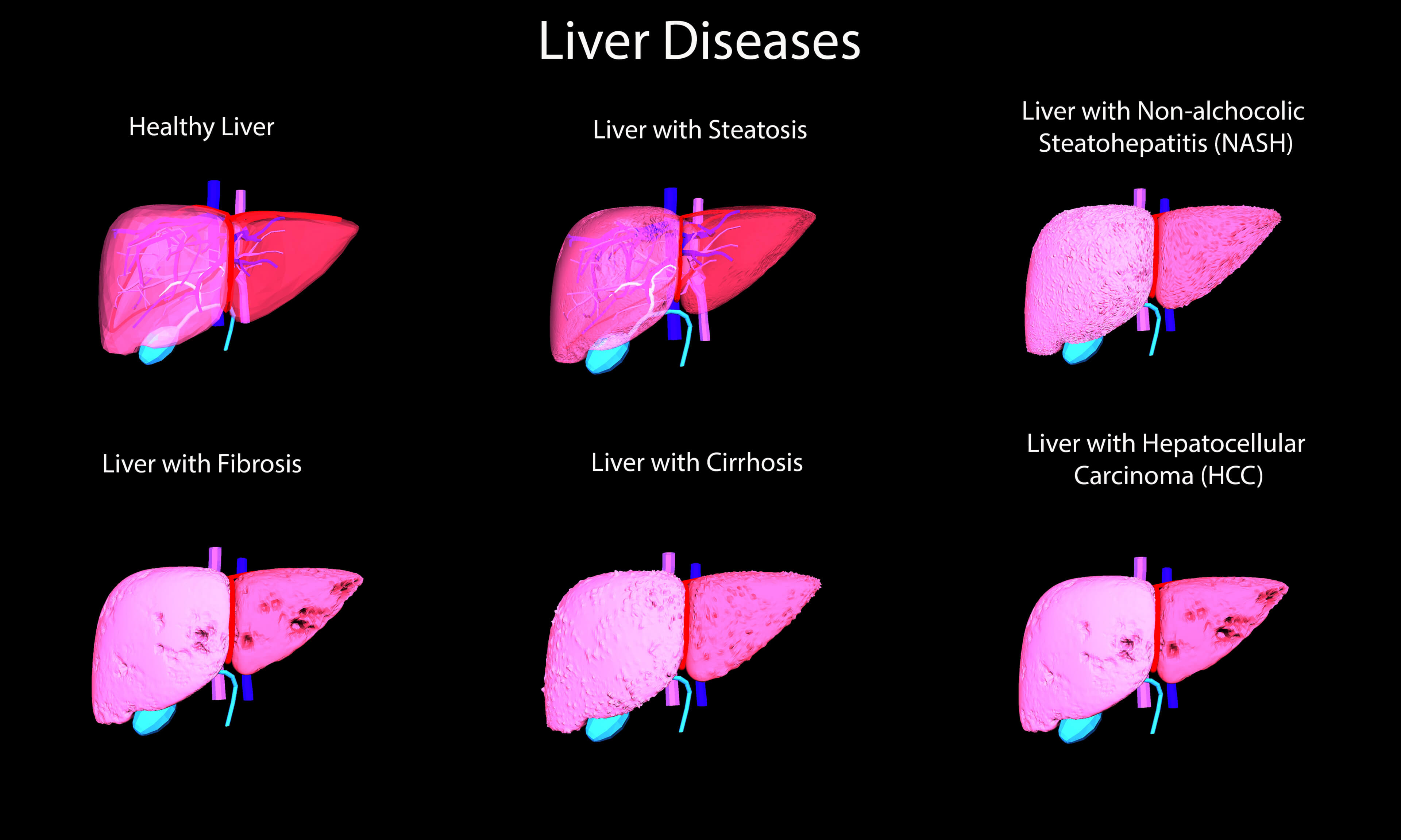 3D Models of Liver Disease - Bundle - 6 Pack by azekapeka