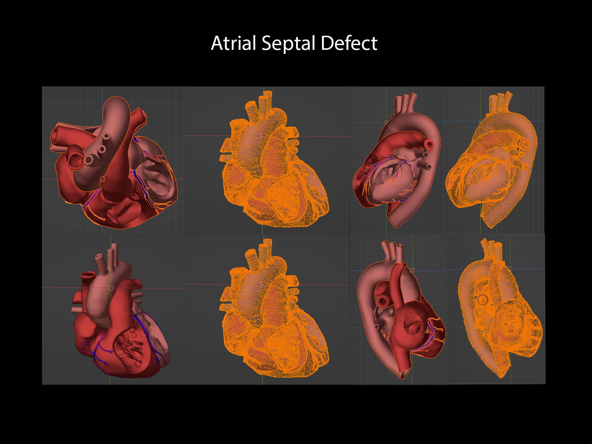 Congenital Heart Disease - 7Pack 3D Model by azekapeka
