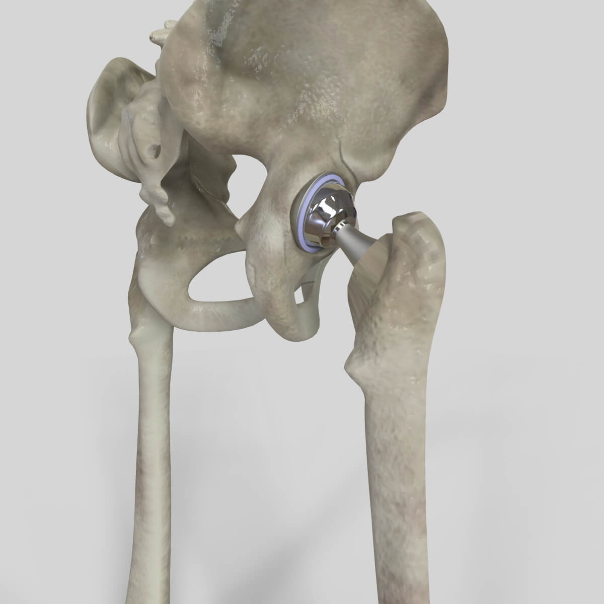 Hip Replacement - 3D Model by AzulUtak
