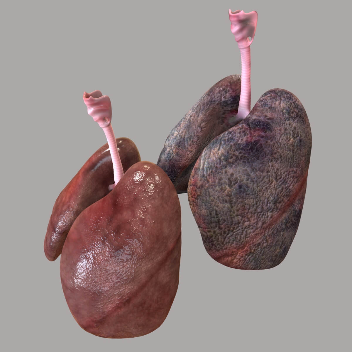 Human Lungs Healthy and Unhealthy - 3D Model by AzulUtak