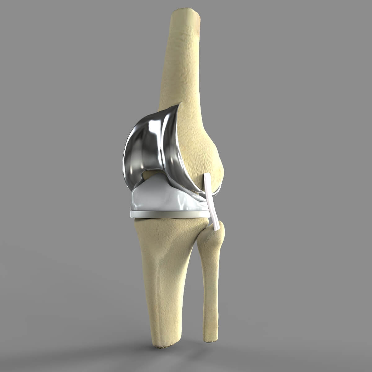 Knee Replacement - 3D Model by AzulUtak