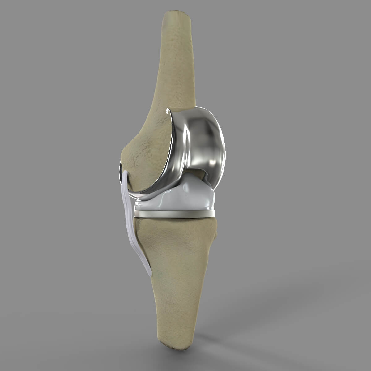 Knee Replacement - 3D Model by AzulUtak