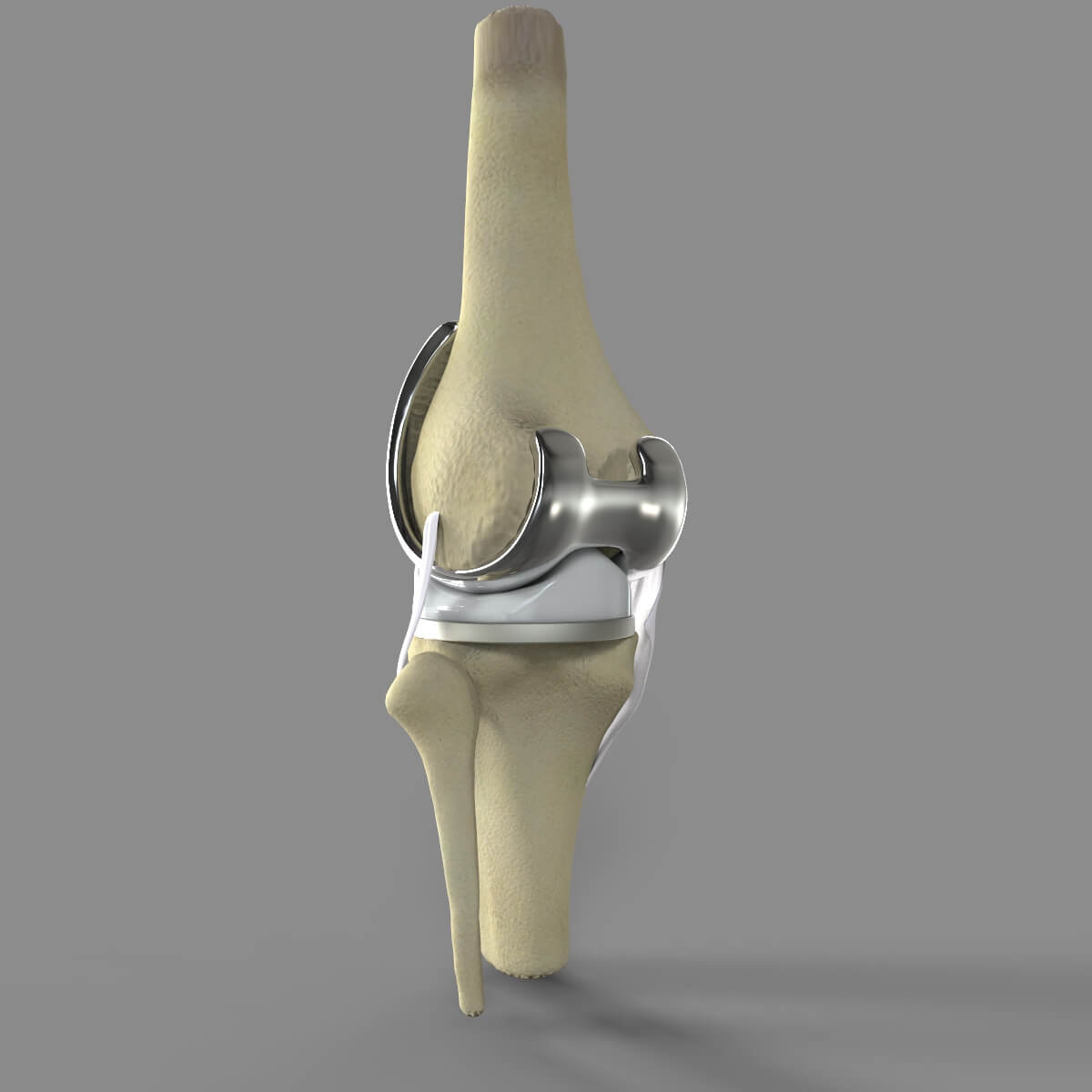 Knee Replacement - 3D Model by AzulUtak