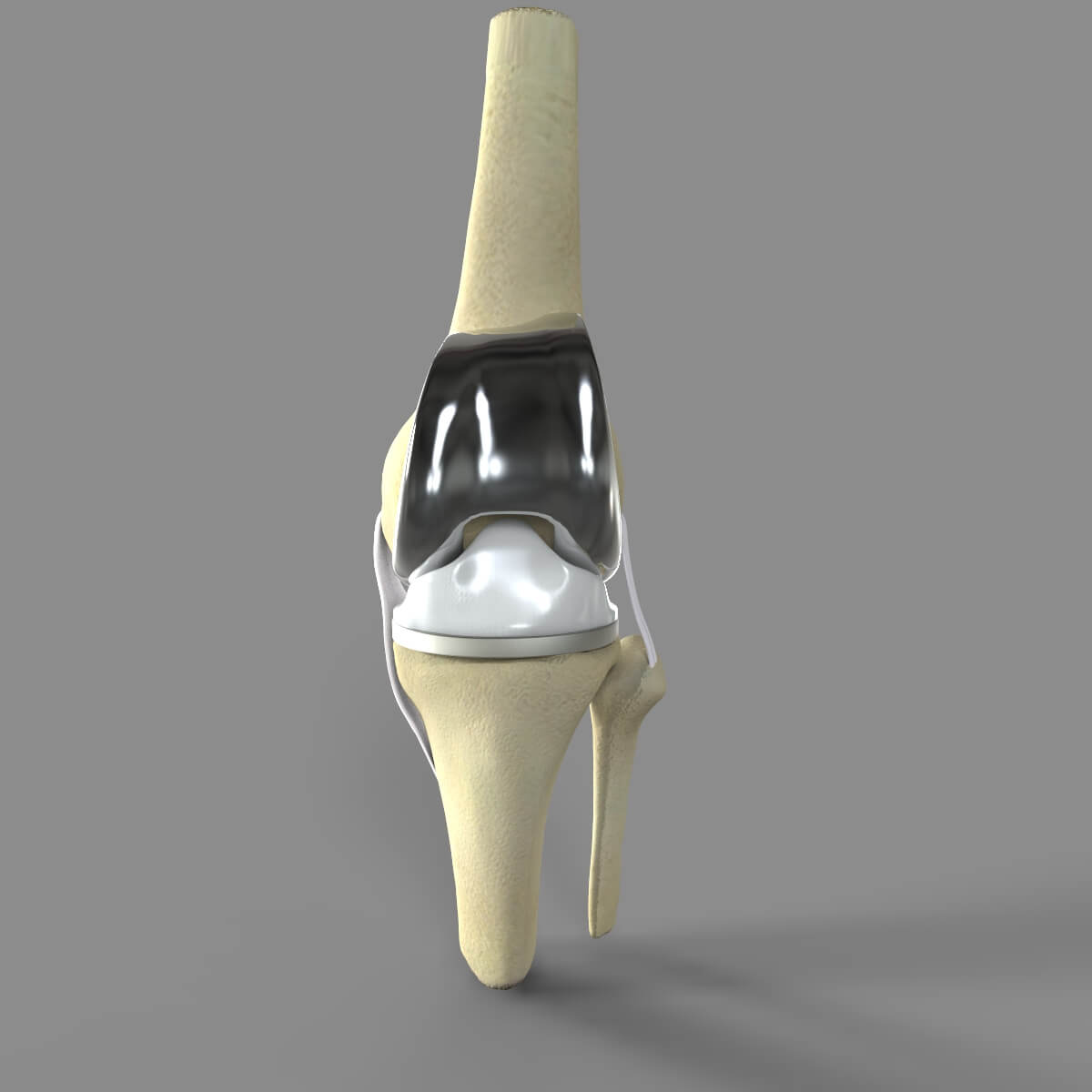 Knee Replacement - 3D Model by AzulUtak