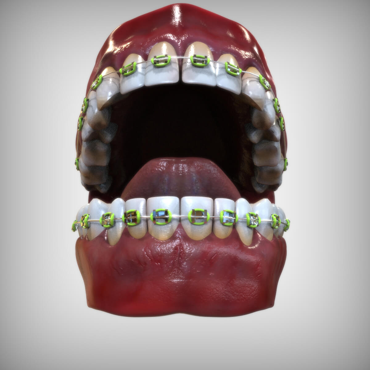 Mouth With Braces - 3D Model by AzulUtak