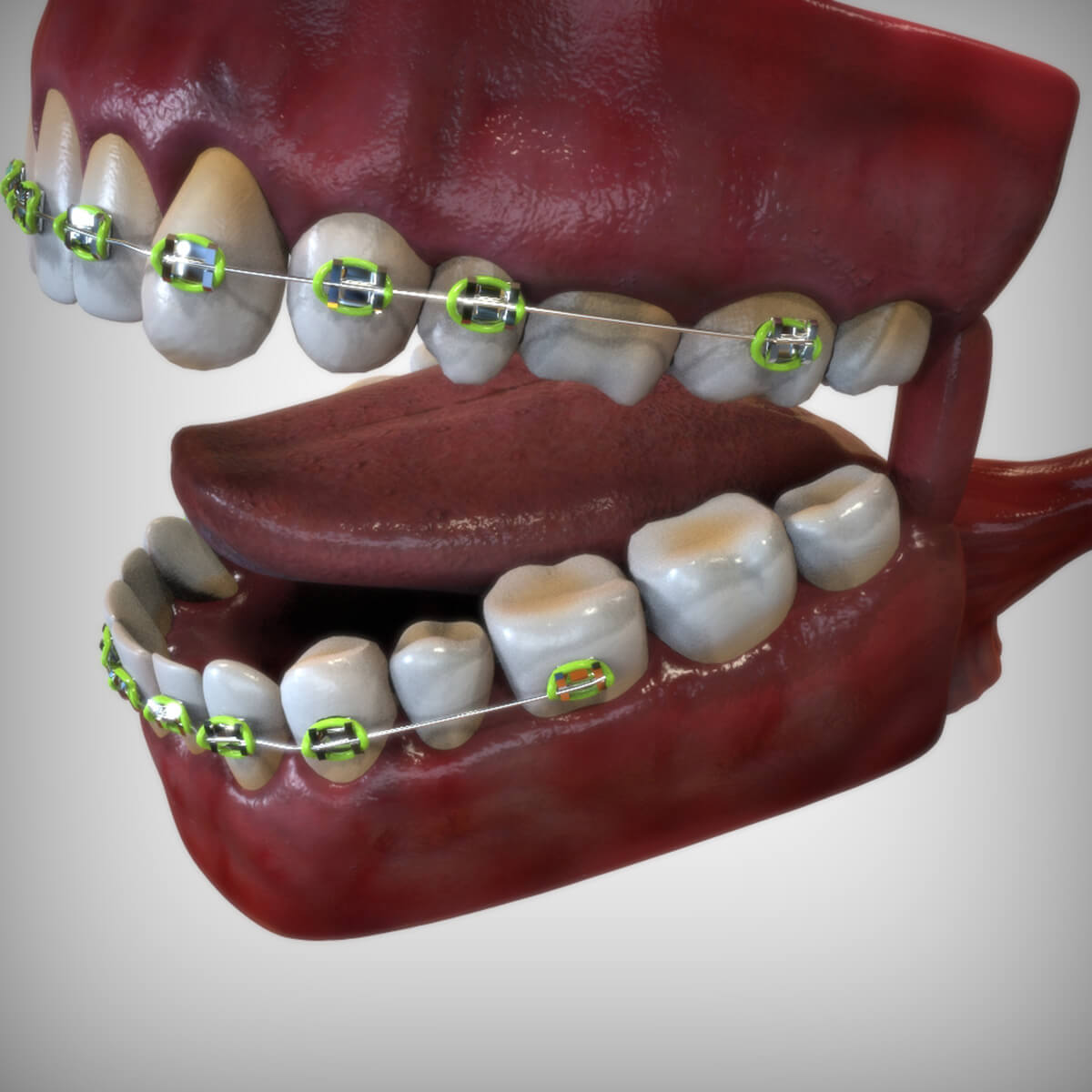 Mouth With Braces - 3D Model by AzulUtak