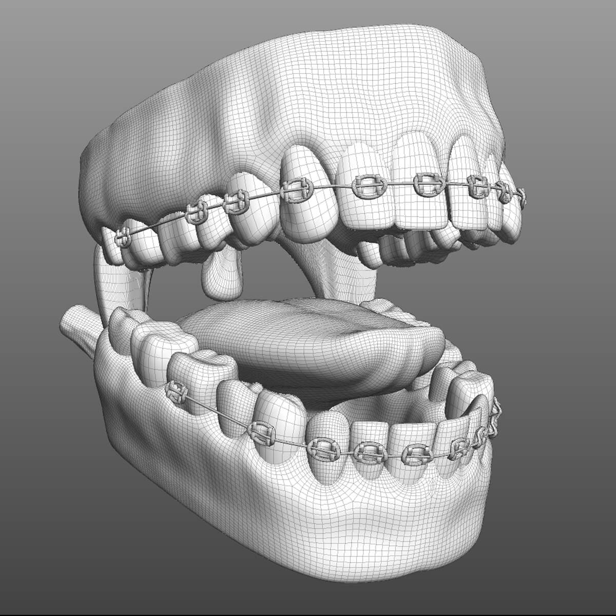 Mouth With Braces 3d Model By Azulutak