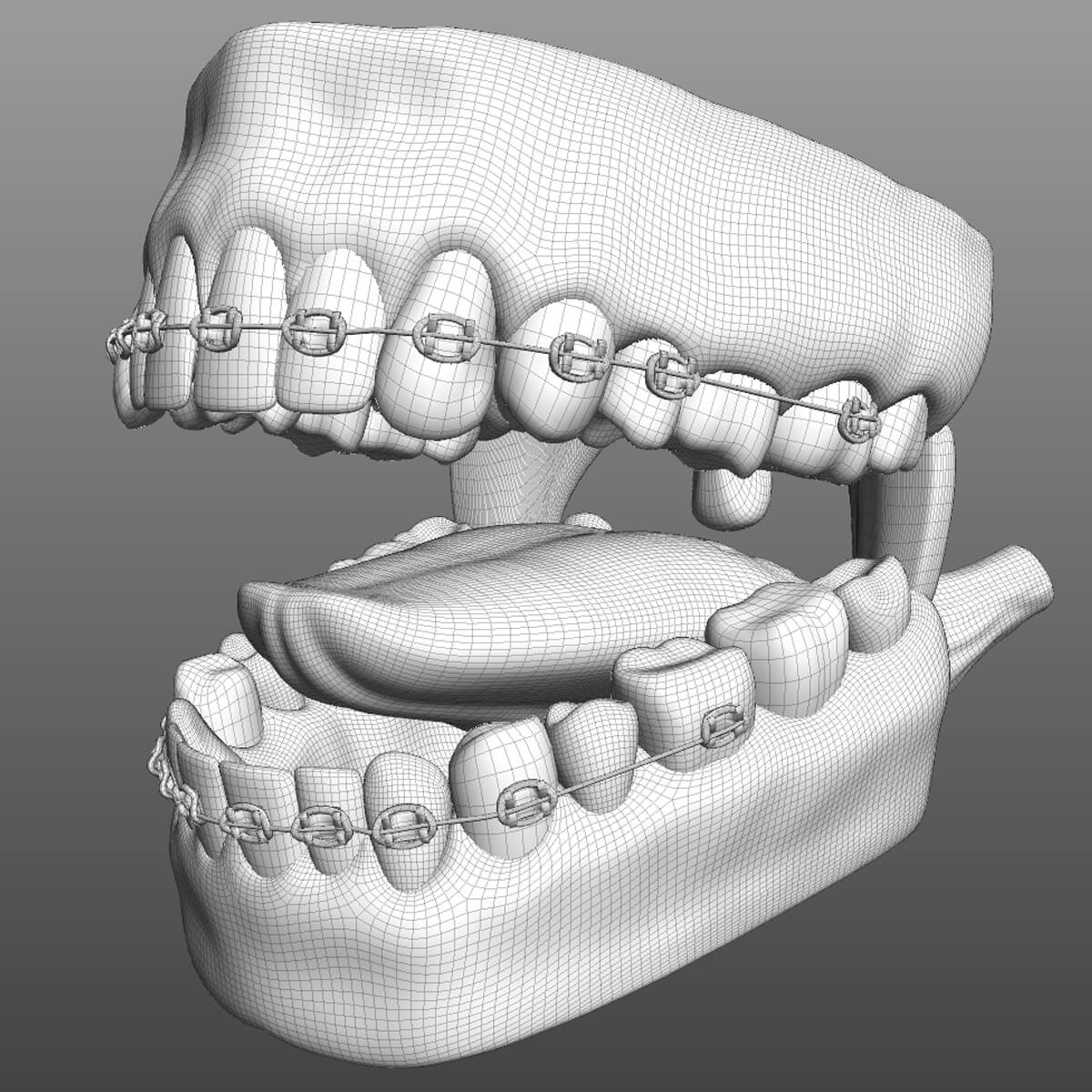 Mouth With Braces - 3D Model by AzulUtak