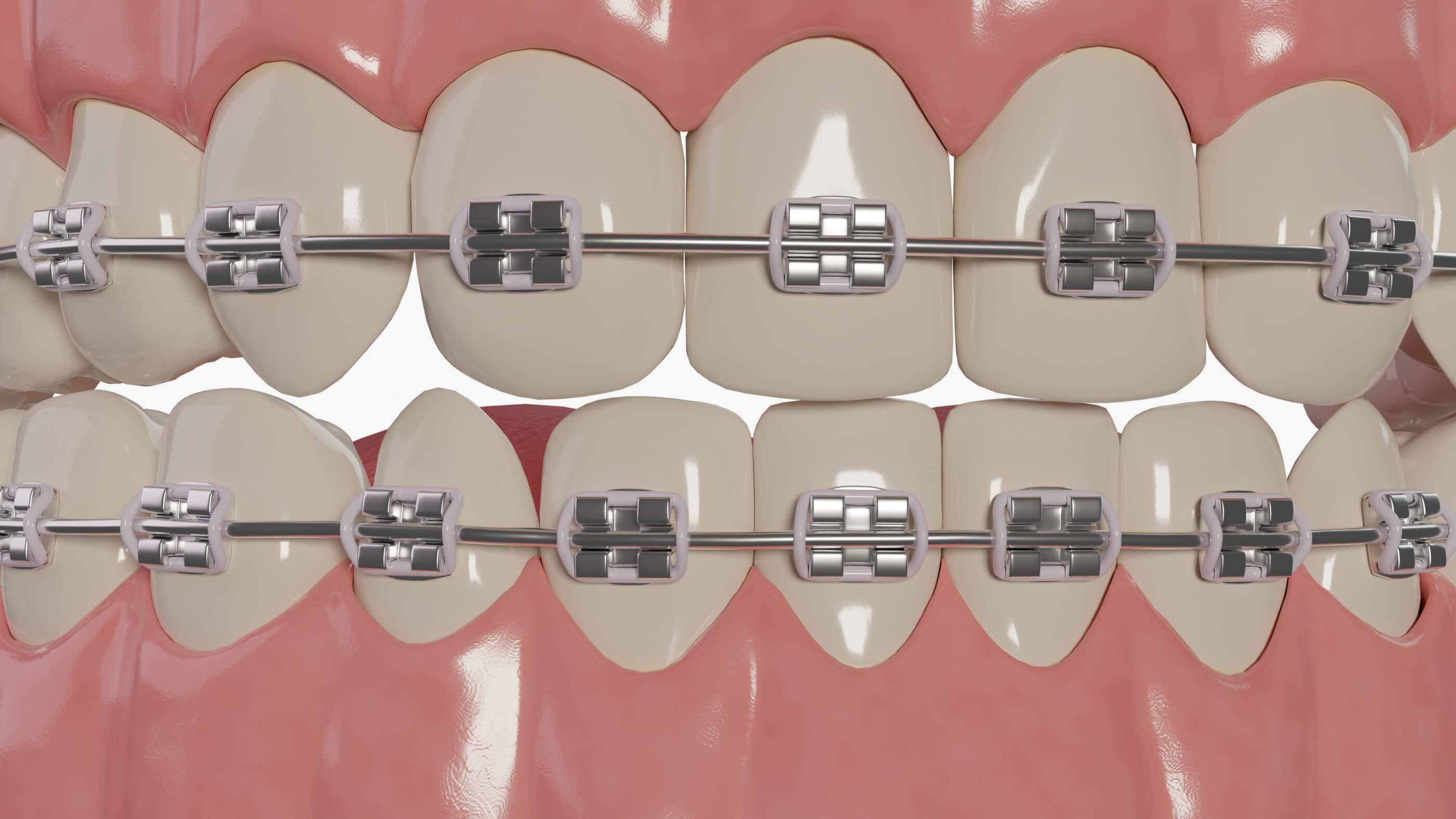 Rubber Bands Braces Faster at Jessie Ramirez blog