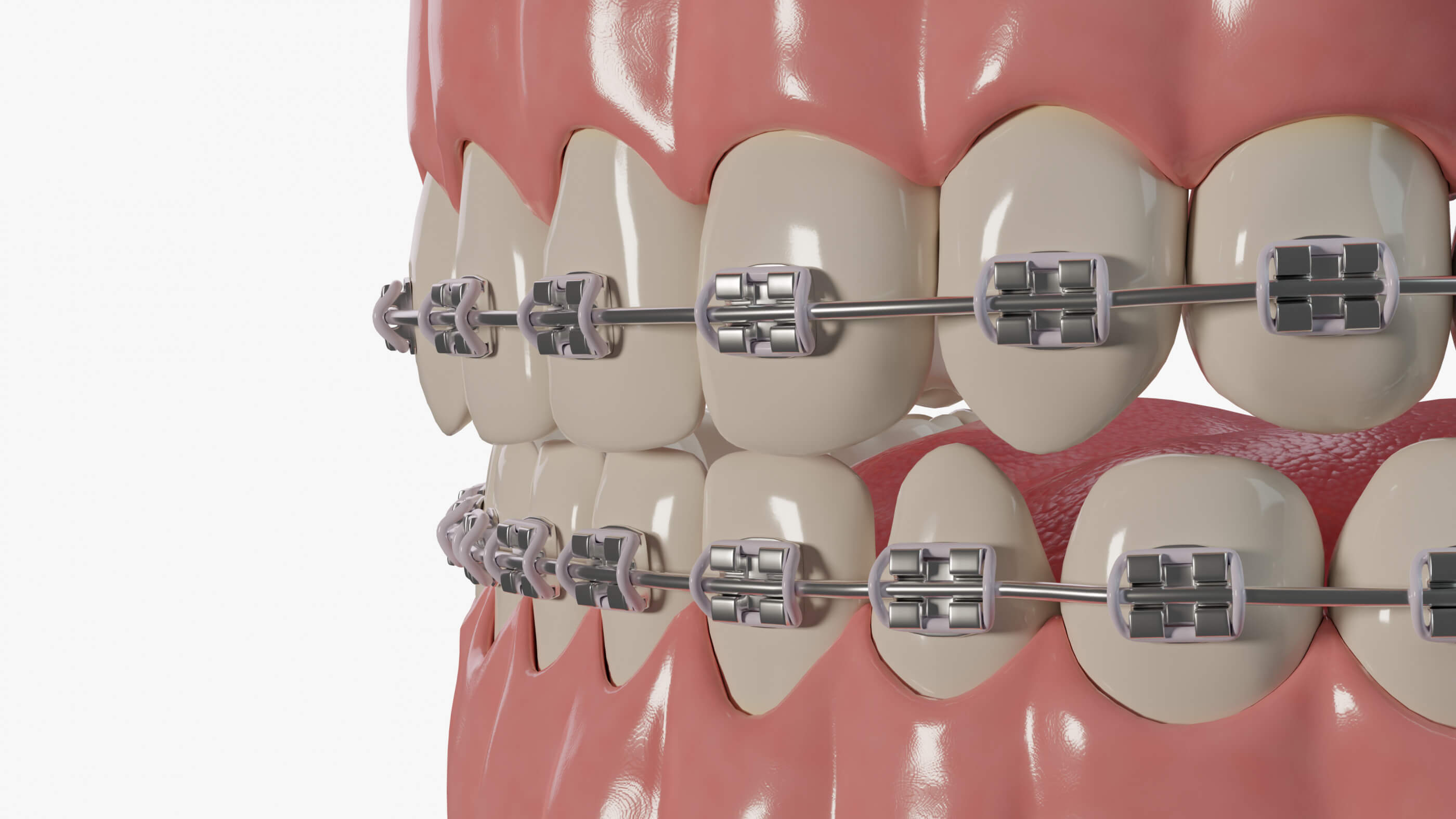 Braces With Elastic Rubber Bands - 3D Model by esfey