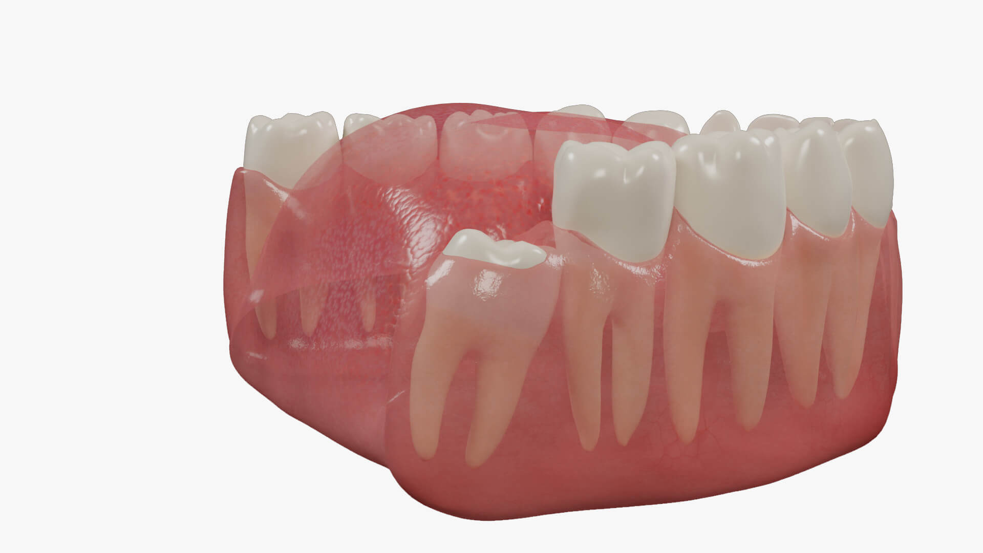 Impacted Wisdom Teeth - 3D Model by esfey