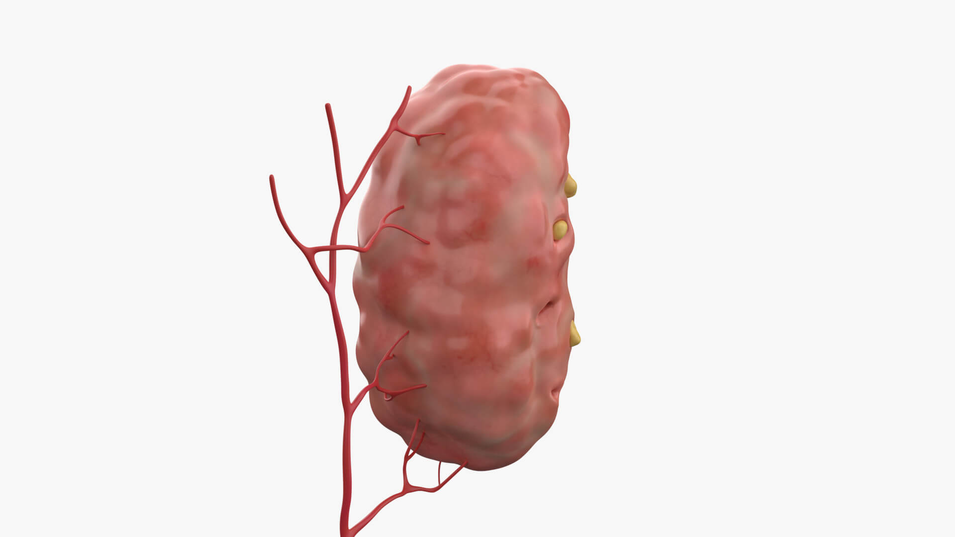 Palatine Tonsil With Tonsilloliths - 3D Model by esfey
